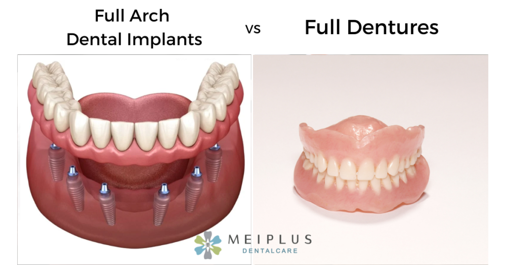 Full Arch Dental Implants Vs Full Dentures : Which Is The Better Choice ...