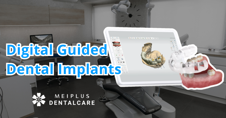 Understanding Digital Guided Dental Implants: A Modern Approach to ...